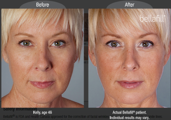 Long-Lasting Collagen Injectables and Dermal Fillers (Bellafill)